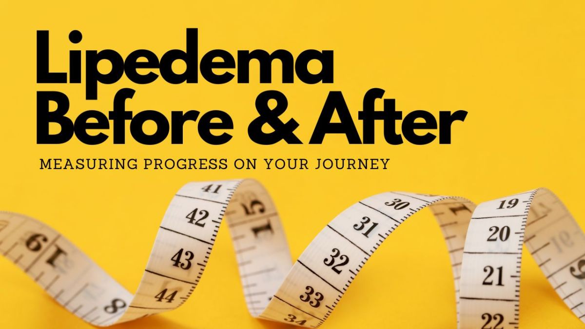 Lipedema Before and After: Measuring Progress on Your Journey – Sturdy ...